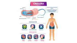 Cholera - Midwives Revision