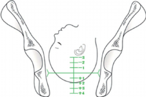 PELVIC ASSESSMENT - Midwives Revision