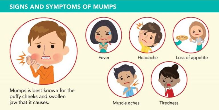 Mumps (Parotitis) - Midwives Revision
